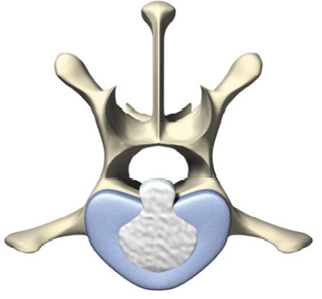Intervertebral Disc Disease – The Canine Genetics Centre